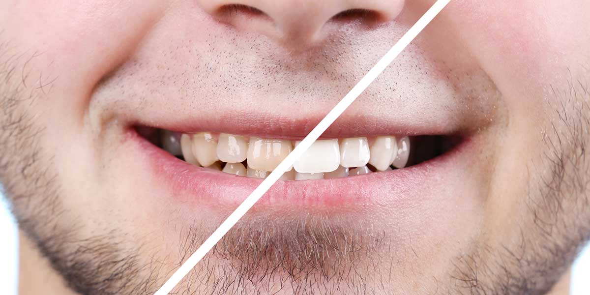 Dental Fillings in Gloucester | Biocompatible Tooth-colored Fillings
